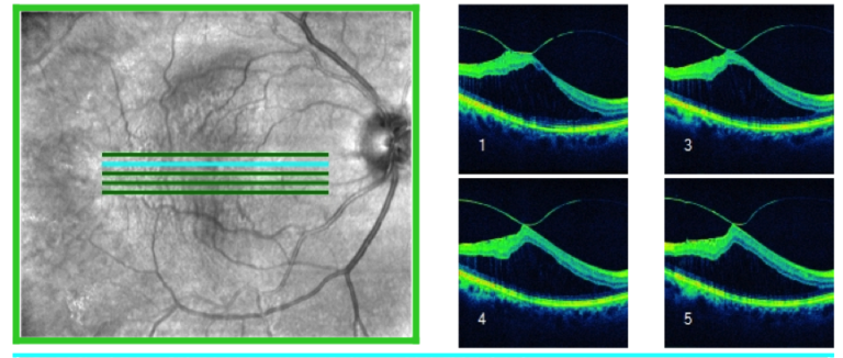 Vitreomacular traction – The Retinal Hub